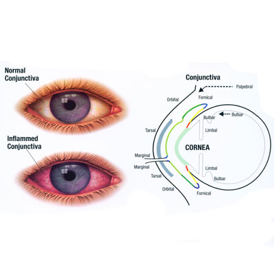 Conjunctivitis | Dove Health