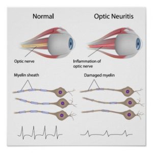 Multiple Sclerosis (MS) Eye Problems | Dove Health